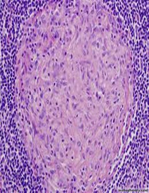 Casseous Necrosis Pptx عملي Muhadharaty