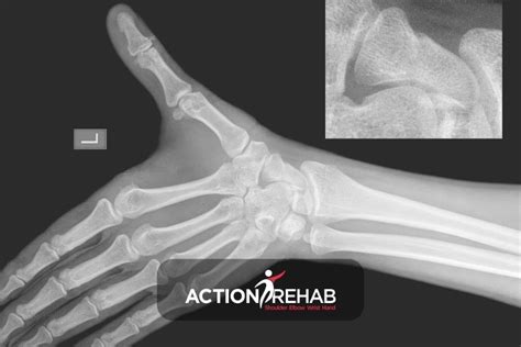 How To Treat A Scaphoid Fracture Action Rehab