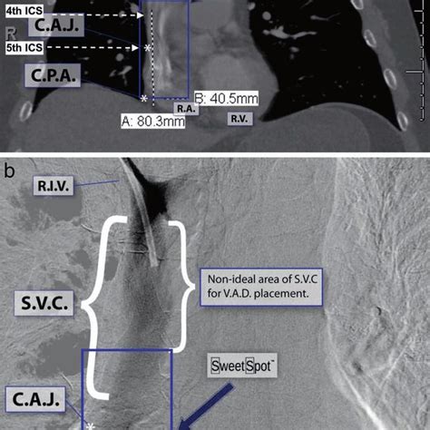Pythagoras Theorem Relating To Ultrasound Beam And Needle Insertion Download Scientific