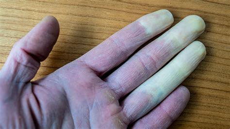 What Is Raynauds Disease Nbc10 Philadelphia