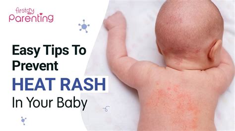 Mild Heat Rash On Stomach
