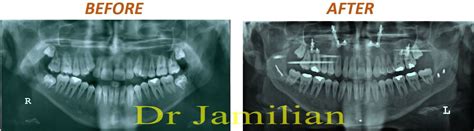 Dr Jamilian Orthodontic Clinic Case Reports Class III Malocclusion