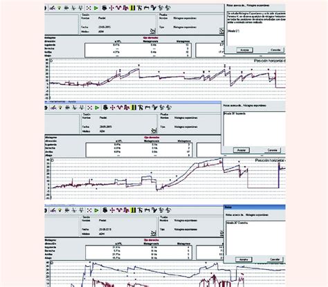 Spontaneous Nystagmus Is Studied And The Patient Is Asked To Issue