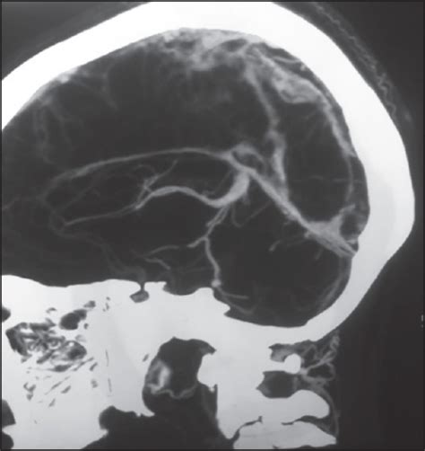 Ct Venogram Of Brain Showing Patent Deep Venous System Open I