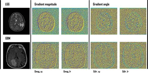 Elongated Quinary Patterns Of Magnitude And Angle Gradients For Brain