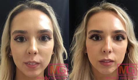 Upper Lip Botox Before And After
