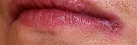 Angular Cheilitis Vs Cold Sore Home Remedies For Angular Cheilitis