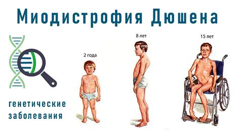 Миодистрофия Дюшена редкое генетическое заболевание Youtube