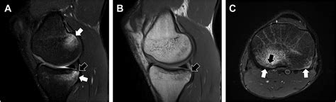 Mr Imaging Of Acute Knee Injuries Radiologic Clinics