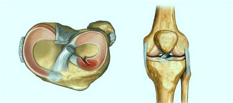 What Does Torn Meniscus Look Like