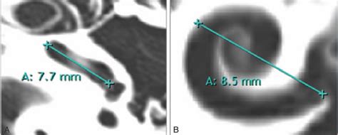 Intra And Interobserver Variability Of Cochlear Length Meas