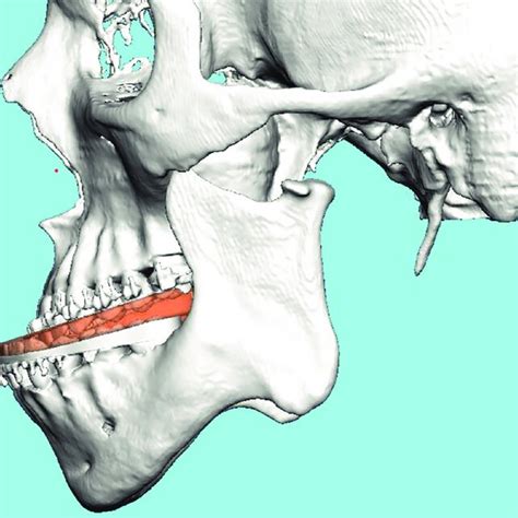 Ct Model With Final Position Of Lower Jaw And Contact Of Coronoid