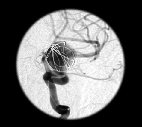 Intracranial Aneurysm Rupture Which Sex Has A Higher Rupture Risk Dermatology Advisor