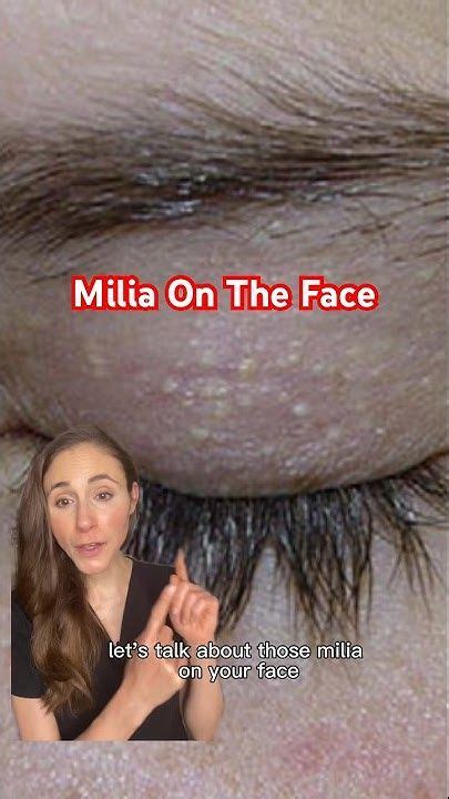 Get Rid Of Your Milia For Good Dermatologist White Bump On Eyelid