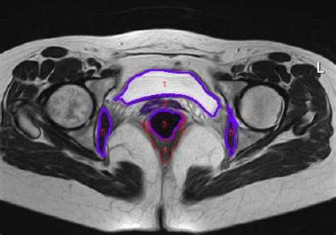 segmentation results of mr image using region growing algorithm
