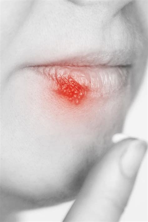 Cold Sores Treatment Services Immediate Care Center