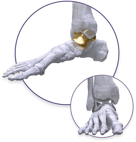 3d Patient Specific Talus Spacer Smart28℠