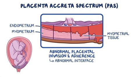 Placenta Accreta Spectrum Clinical Sciences Osmosis Video Library
