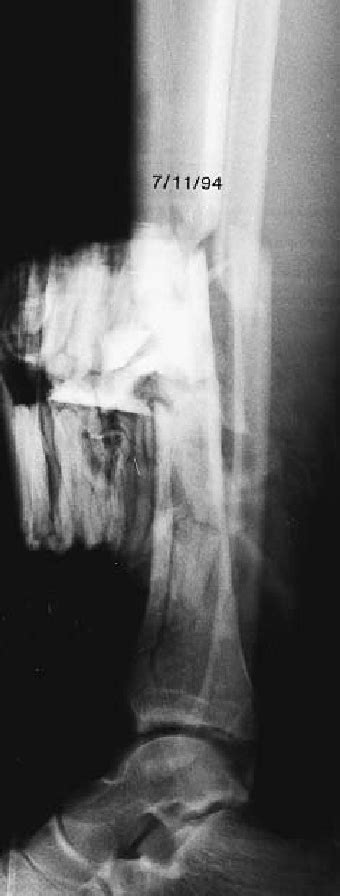 A B Ap And Lateral Radiographs Showing Grade Iiib Open Fracture Of The Download Scientific
