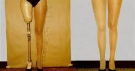 Endoskeletal And Exoskeletal Prosthesis