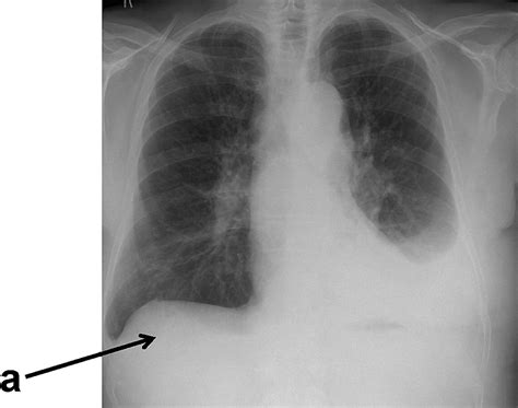 Investigation Of A Unilateral Pleural Effusion In Adults British