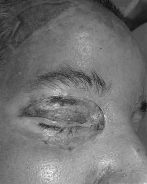 Upper Eyelid Excision Forehead Excision Was Performed At The Same Time Download Scientific