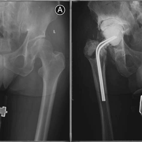A Preoperative X‐ray Showed Displaced Acetabular Component And Severe Download Scientific