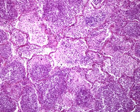 Pneumonia Light Micrograph Stock Image C056 1677 Science Photo Library