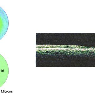 Left OCT Color Retinal Map Top And Thickness Map Bottom Showing Download Scientific