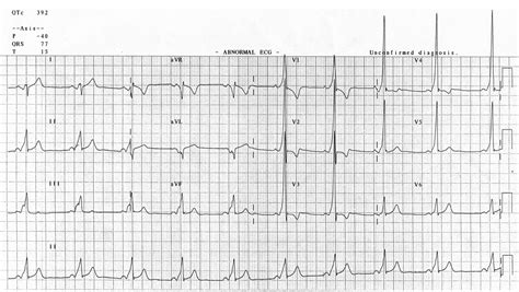 Wolff Parkinson White Emergency Medicine Education Resus