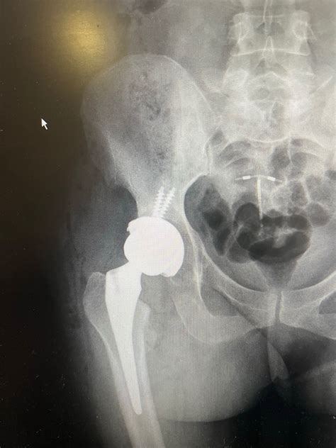 Hamed Alsarhan On Linkedin Revision Of Acetabular Component Of A Tha Due To Loosening Of The Shell