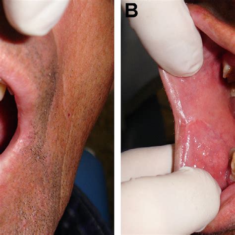 A Submucosal Nodule Covered By Intact Mucosa Presenting A Purplish Download Scientific