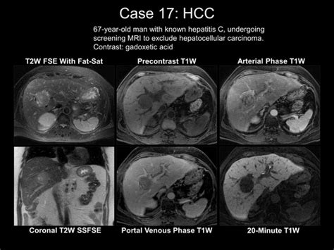 Liver Imaging With Mri