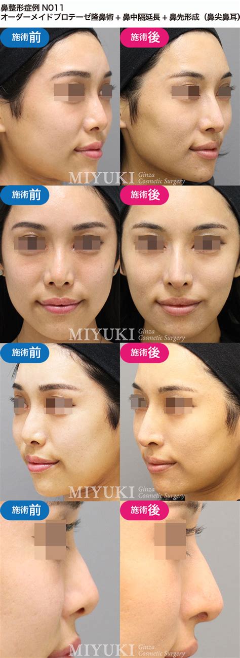 豚鼻（鼻の穴が見える）などお悩みには鼻中隔延長。スッキリ整ったきれいな鼻先を実現 ｜美容整形｜東京・中央区・銀座｜大阪・梅田
