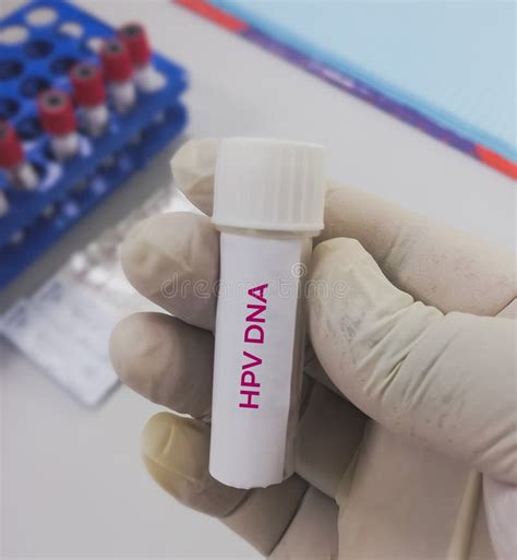 Testing Tube With Vaginal Fluid Sample For HPV DNA Test Stock Photo Image Of Penile Newborn