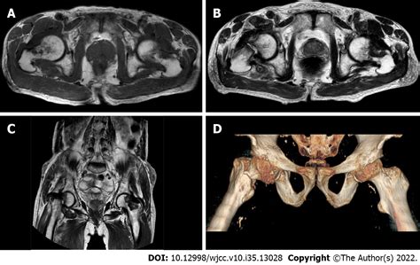 Multiple Myeloma Presenting With Amyloid Arthropathy As The First