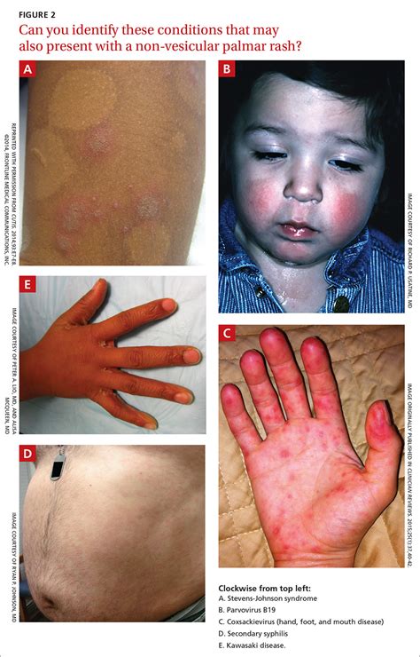 Mildly Pruritic Palmar Rash Mdedge