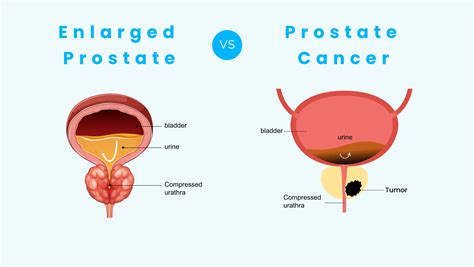 Enlarged Prostate Vs Prostate Cancer Symptoms Shouldnt Ignore