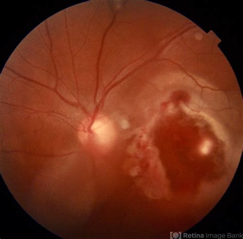 Traumatic Macular Hole Retina Image Bank