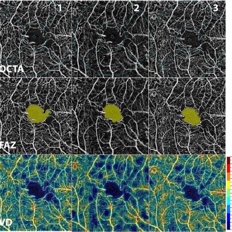En Face Octa Imaging Of The Superficial Retinal Capillary Plexus Scp