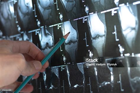 뼈 무릎 종양을 검사하는 의사 X선 및 Mri Mrt Ct 및 Nidus 주위에 현저한 경화증이 있습니다 의료 Treatmant 개념 질병 인간 뼈의 진단 엑스레이 이미지에
