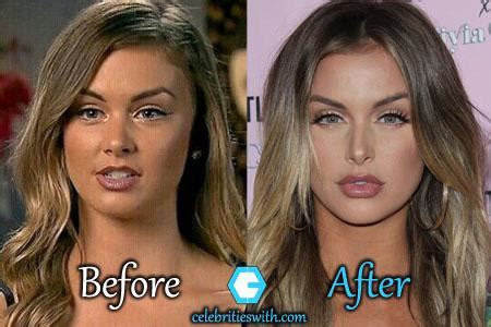 Lala Before And After Surgery