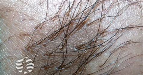 Hypertrichosis Image