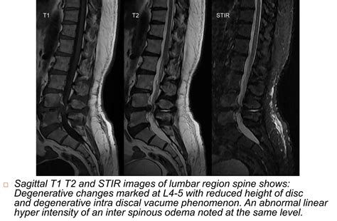Baastrups Diseasepptx