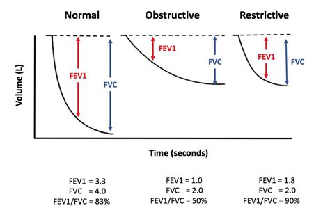 Spirometry Test For Copd Fev1fvc At Karin Wright Blog