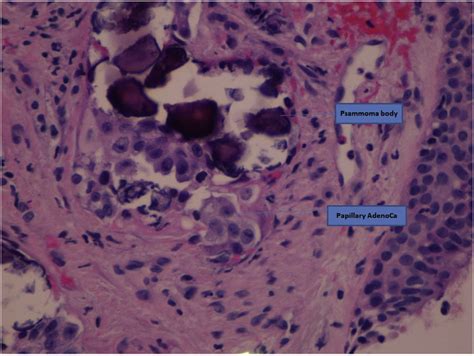 High Resolution Papillary Lung Adenocarcinoma With Psammomatous Download Scientific Diagram