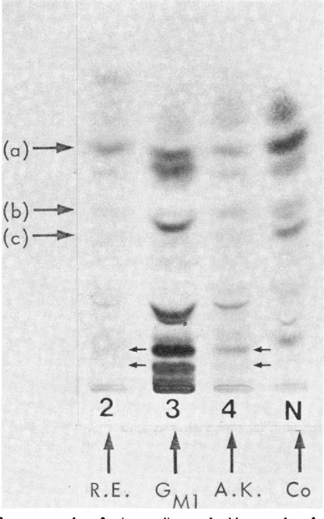 Figure 1 From Morquio Syndrome Mucopolysaccharidosis Iv B Associated