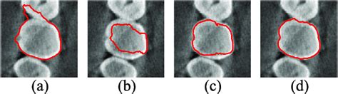 Tooth Segmentation Respectively By A The Level Set Geodesic Flow In Download Scientific