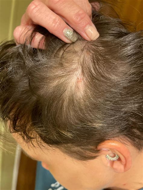 Atopic Dermatitis Scalp Eczema Reczema