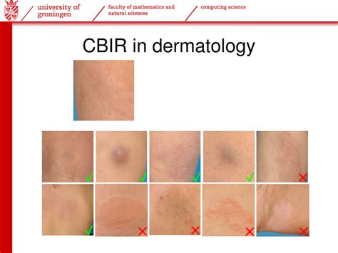 Ppt Content Based Image Retrieval Cbir Of Dermatological Images Powerpoint Presentation Id